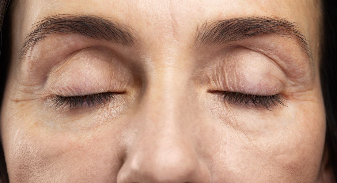 CO₂ Laser for Crow’s Feet & Under-Eye Wrinkles (Guide)