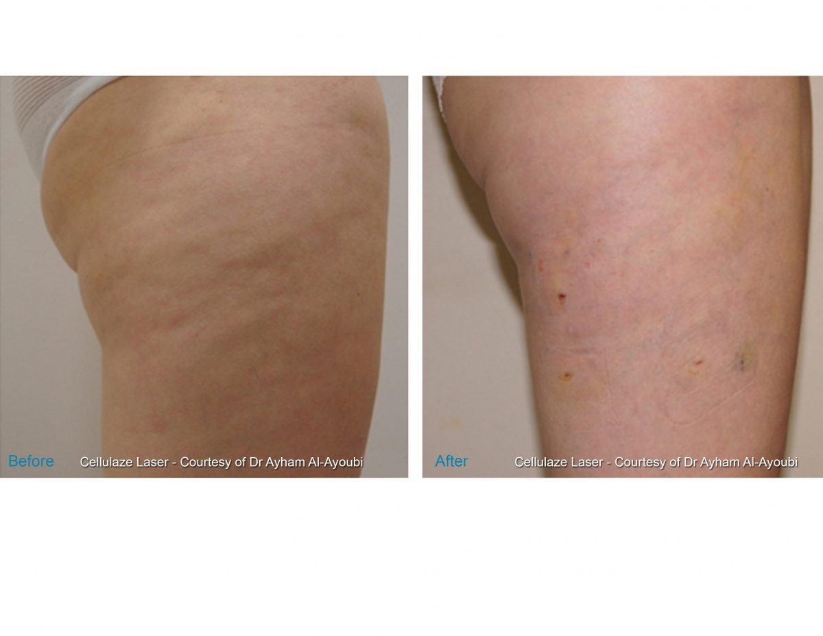 Cellulaze Laser for Permanent Cellulite Reduction by Dr Ayham Al-Ayoubi | LMA Clinic