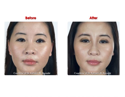 Aquamid – By Dr Ayham Al-Ayoubi | LMA Clinic