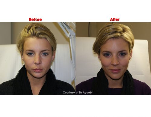 Ellanse – Courtesy of Dr Ayham Al-Ayoubi | LMA Clinic