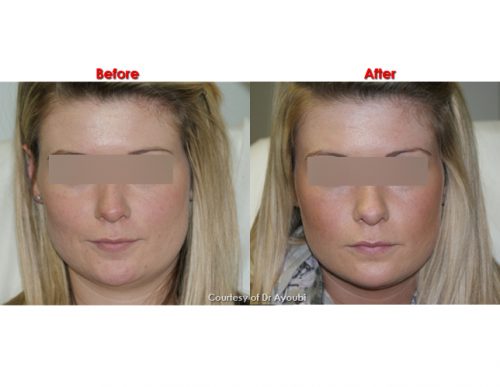 Ellanse – Courtesy of Dr Ayham Al-Ayoubi | LMA Clinic