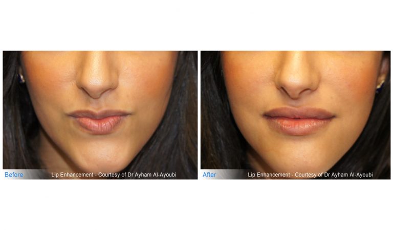 lip-enhancement-3 | LMA Clinic
