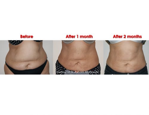 Smartlipo Laser Liposuction – By Dr Ayham Al-Ayoubi | LMA Clinic