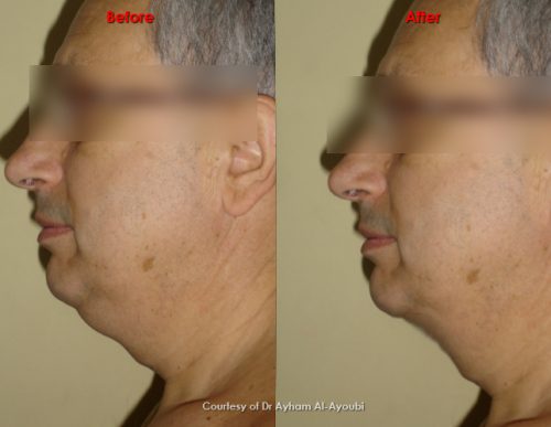 smartlipo-laser-liposuction-chin-dr-ayham-al-ayoubi-7 | LMA Clinic
