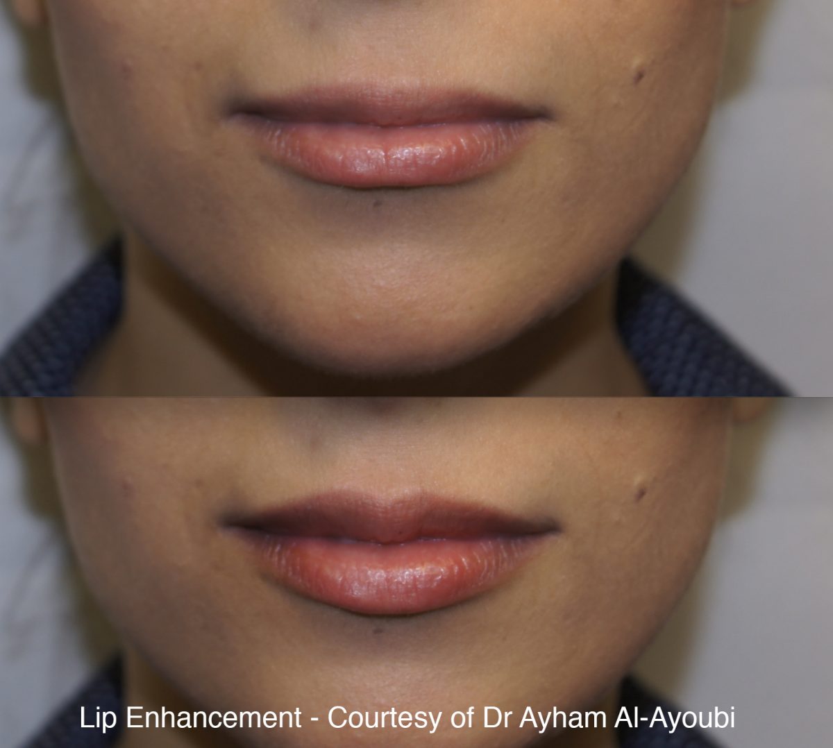 Lips_Enhancement_DR_Ayham_Al-Ayoubi (13) | LMA Clinic