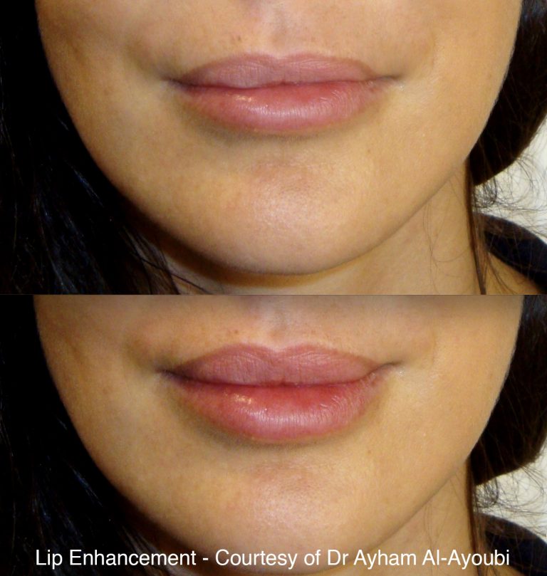 lips-enhancement_Dr_Ayham _Al-Ayoubi (1) | LMA Clinic